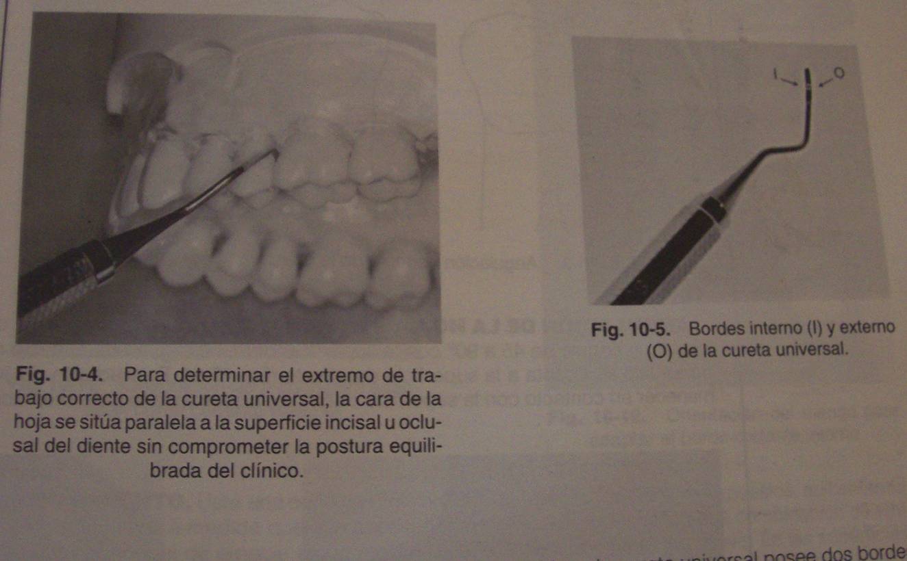 Curetas Universales | Odontoblog