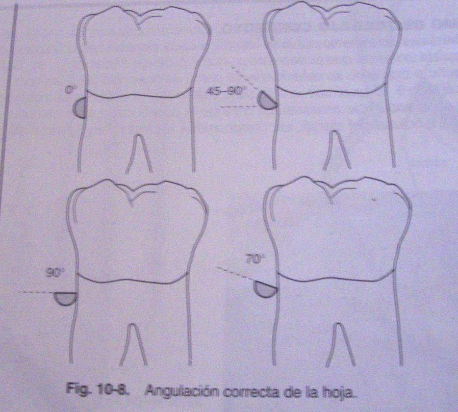 Curetas Universales | Odontoblog